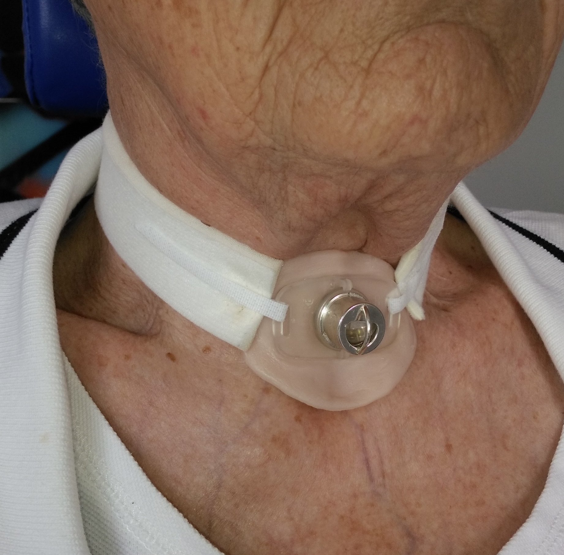 Tracheostoma – Epitheseninstitute Schneider